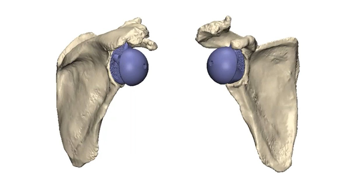 Webinar: Complex Shoulder Replacements in Prof.Ekhom Practice