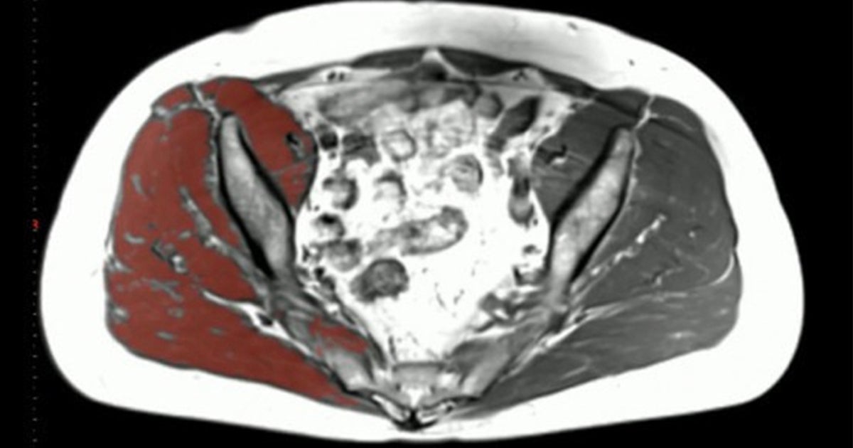 How to Segment Muscles Semi-Automatically in Mimics