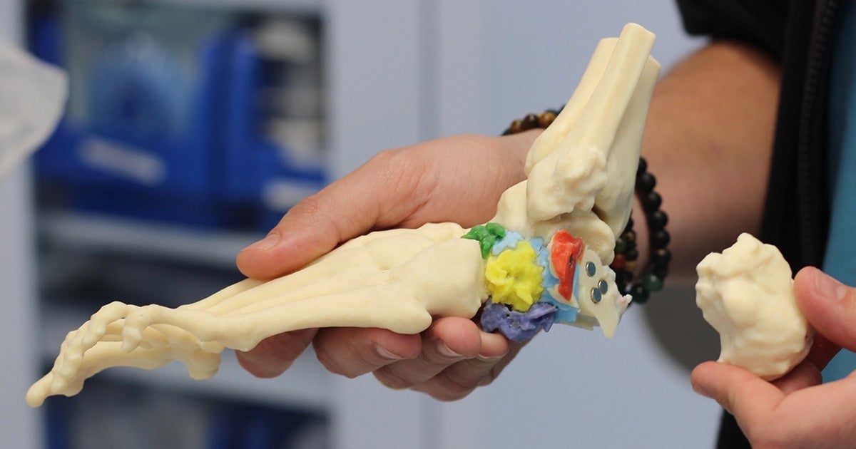 A View into a Growing Sector: Total Ankle Replacements