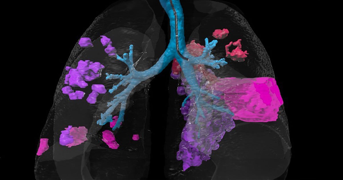 Making Pulmonary Interventions Truly Personalized: From Treatment ...