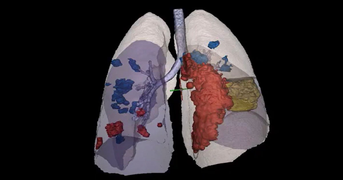 How to View Cases in Mimics Viewer | Materialise