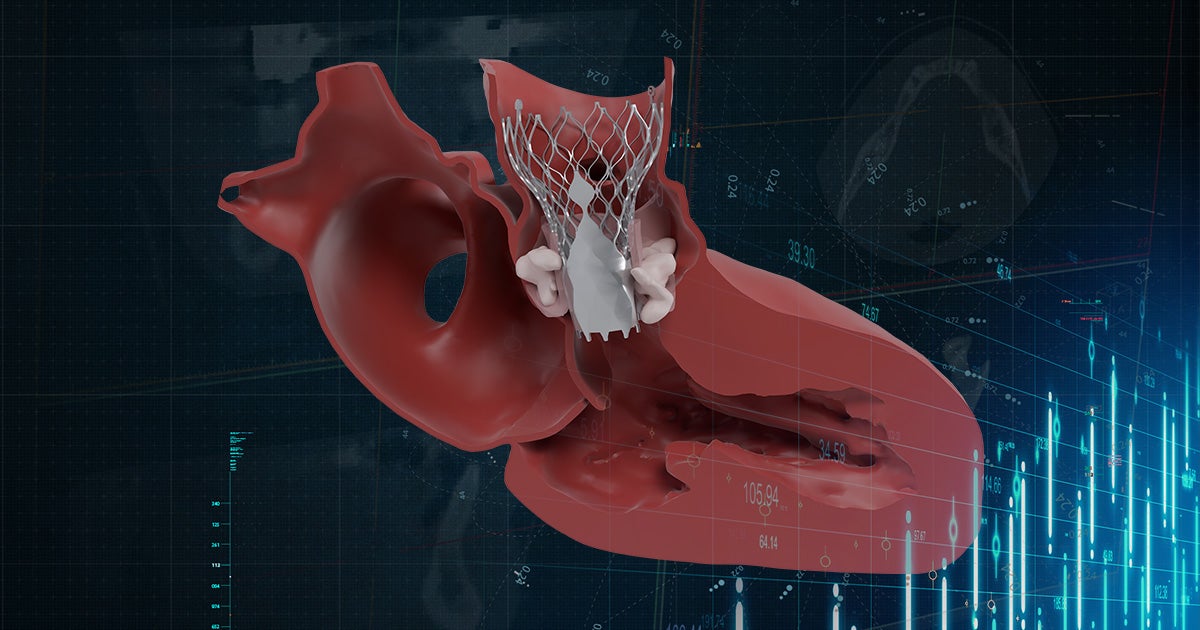 Optimizing Complex Cardiac Device Development