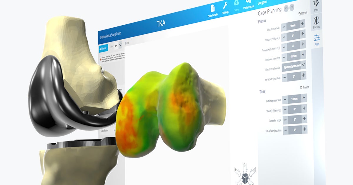 Knee Guides Precisely Execute Personalized TKA Alignment