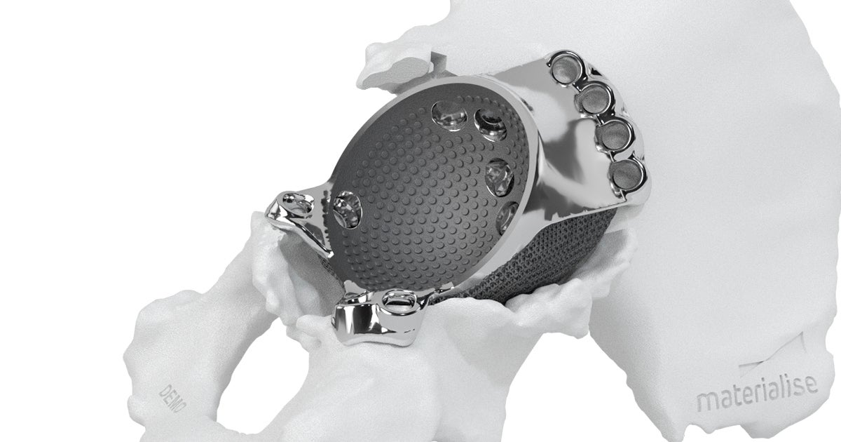 3D-Printed Hip Joint Held in Place with Stem Cells