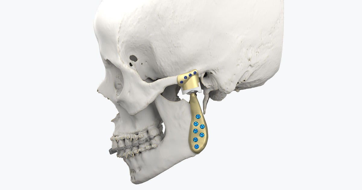 Webinar: Enhance Surgical Precision for TMJ Arthroplasty