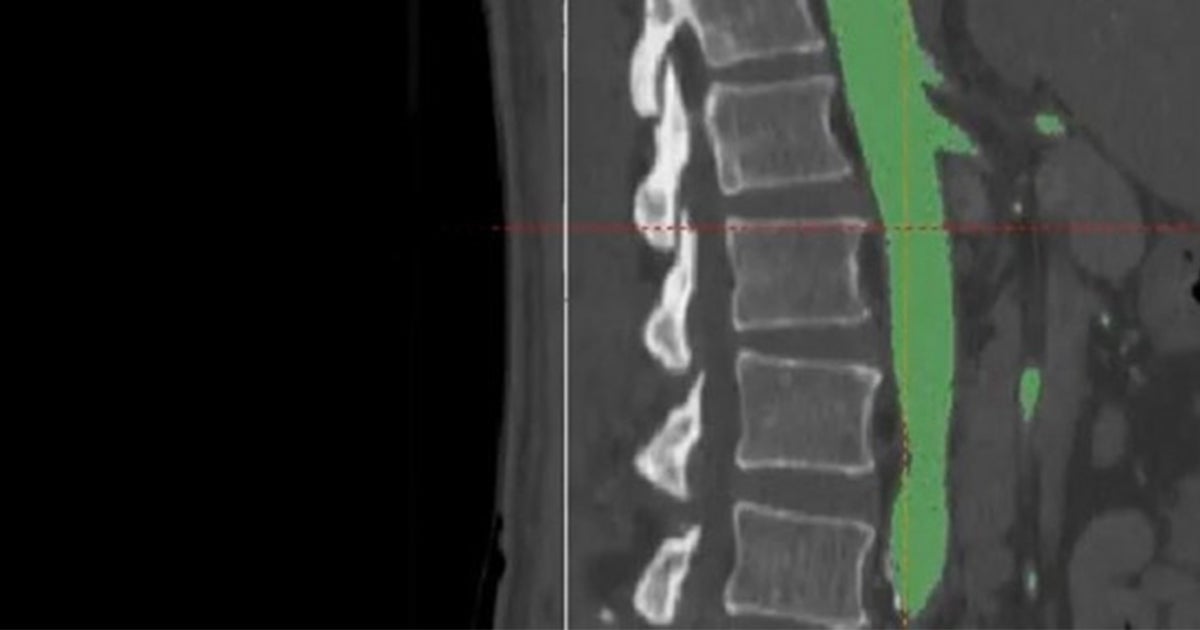 How to Use Dynamic Region Growing in Mimics