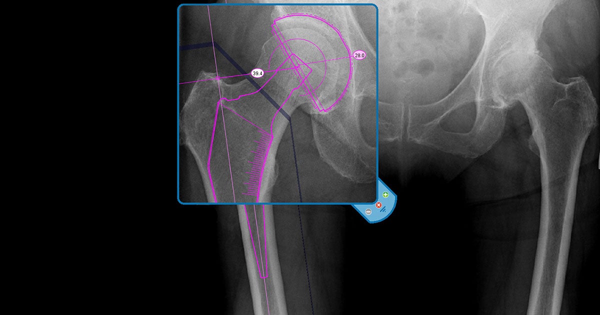 Materialise OrthoView Training | Materialise Healthcare Academy