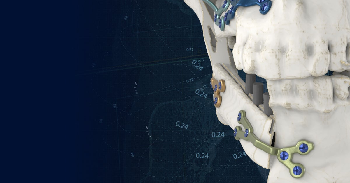 Reconstructive Surgery | Cranio-Maxillofacial Solutions | Materialise
