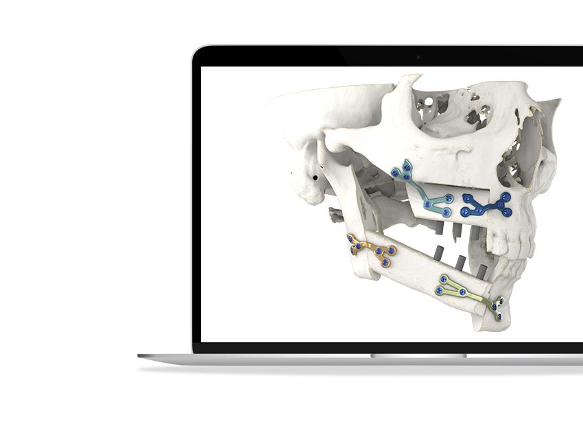 Webinar Innovations In Cmf Reconstructions