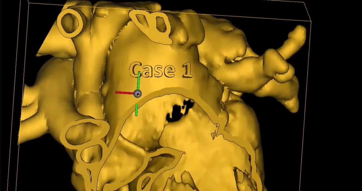 Mimics inPrint ビギナー向けウェビナー vol.2 心臓中空モデルの作成