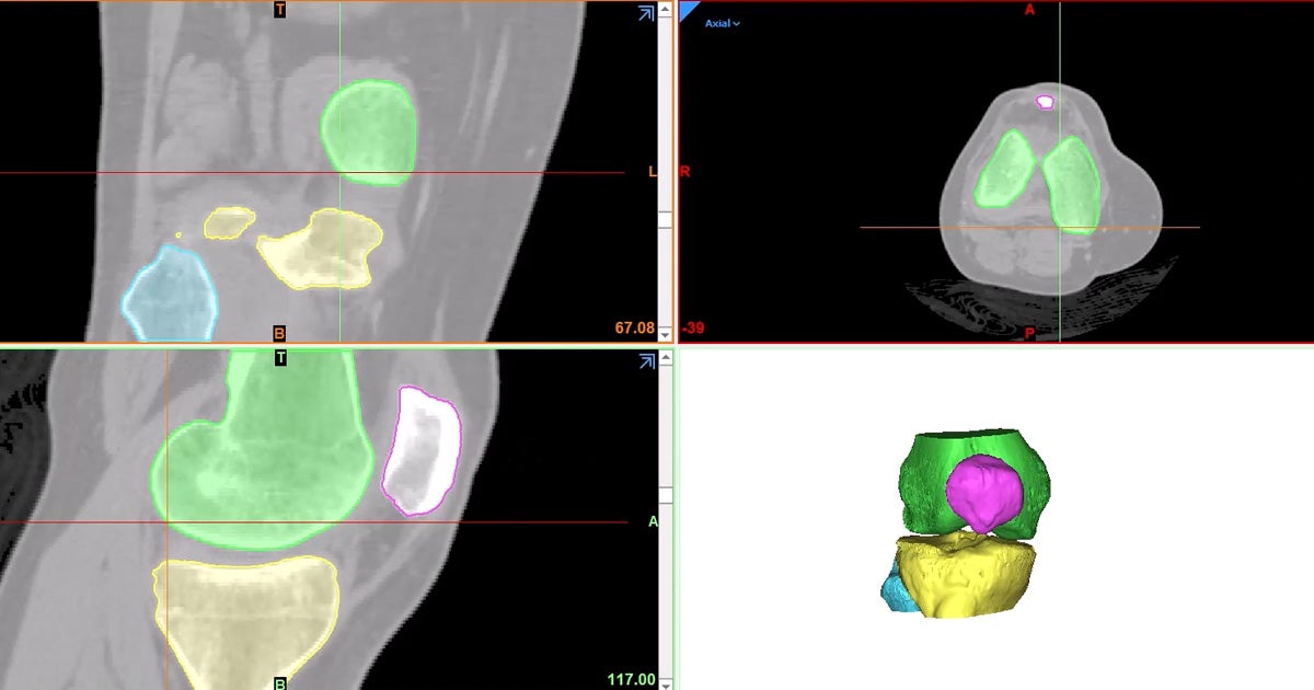 Tutorial: Introduction to the CT Bone Wizard