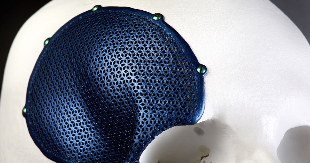 Webinar: 5 Ways to Optimize the Medical Device Design Process