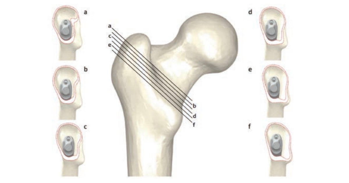 Virtual Population Analysis Improves Orthopedic Implant Design