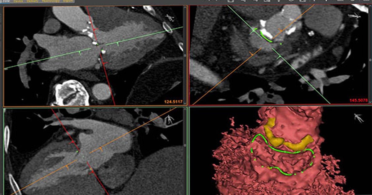 Discover the Mimics Enlight TMVR Planner