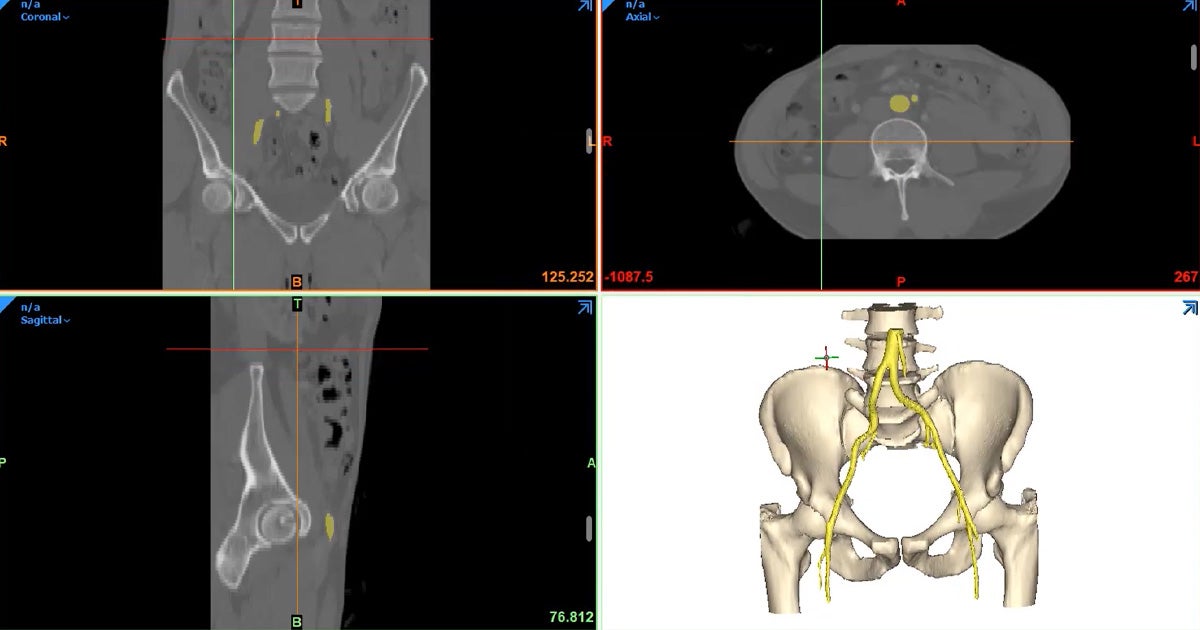 Tutorial: How to Use Dynamic Region Growing in Materialise Mimics Core