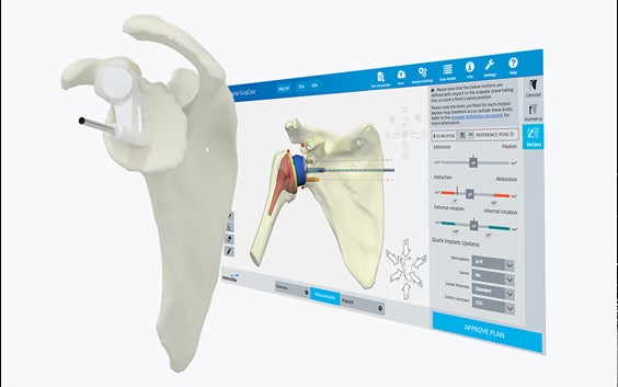 Personalized 3D Planning and Guides for Shoulder Arthroplasty