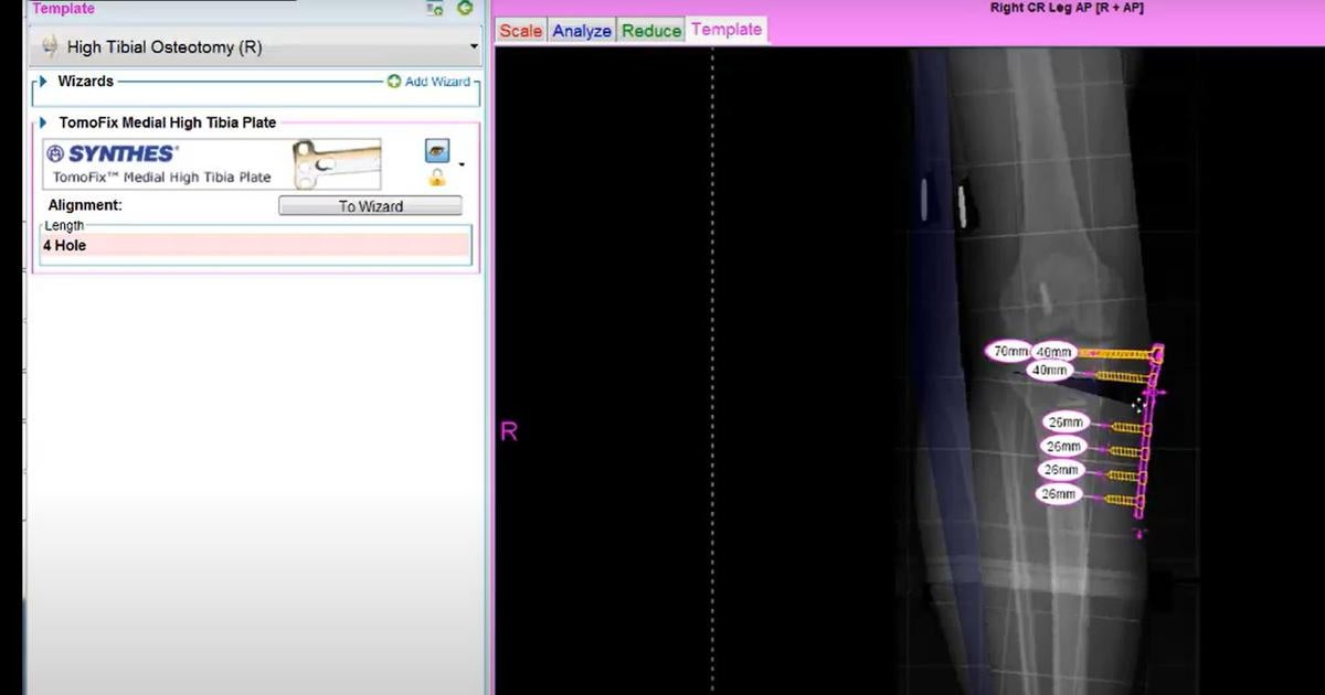 How to Plan a High Tibial Osteotomy in Materialise OrthoView
