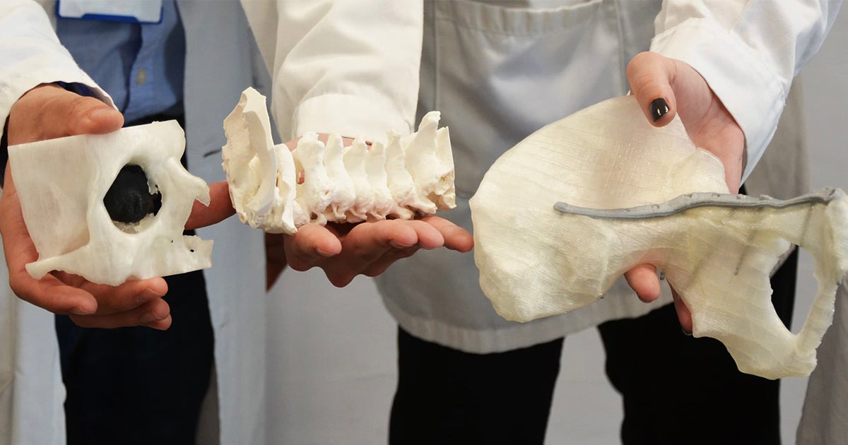 3D Printing Transforms Surgical Care with Optimal Outcomes