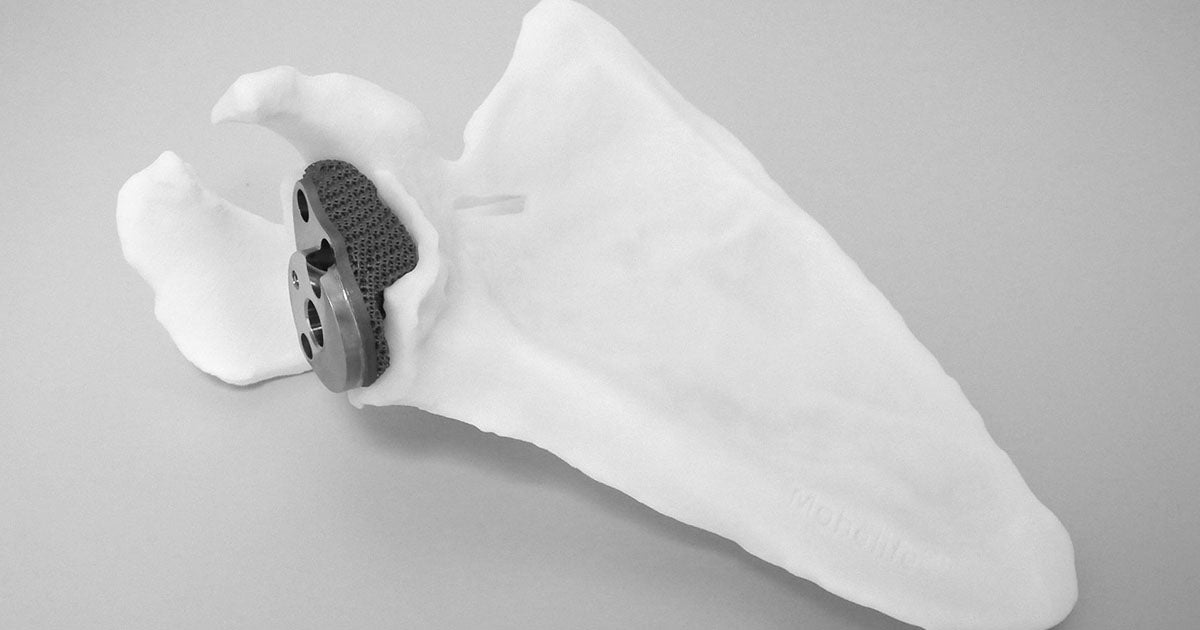 Personalized Shoulder Implant Enables Life-Transforming Shoulder Surgery