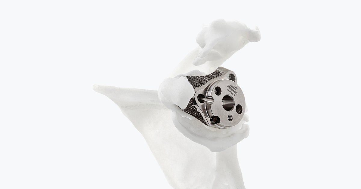 Complex Glenoid Deficiencies: Indications for Patient-Specific Implants