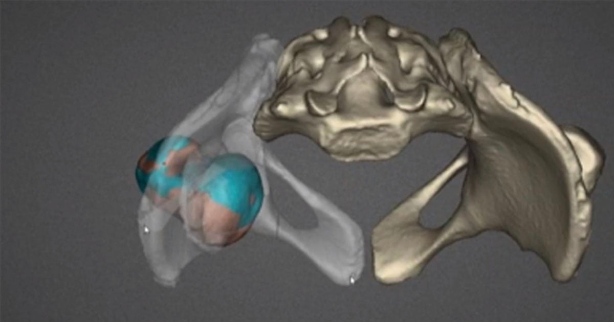 The Use of 3D-Printed Pelvic Models for Complex Acetabular and Femoral Reconstructions