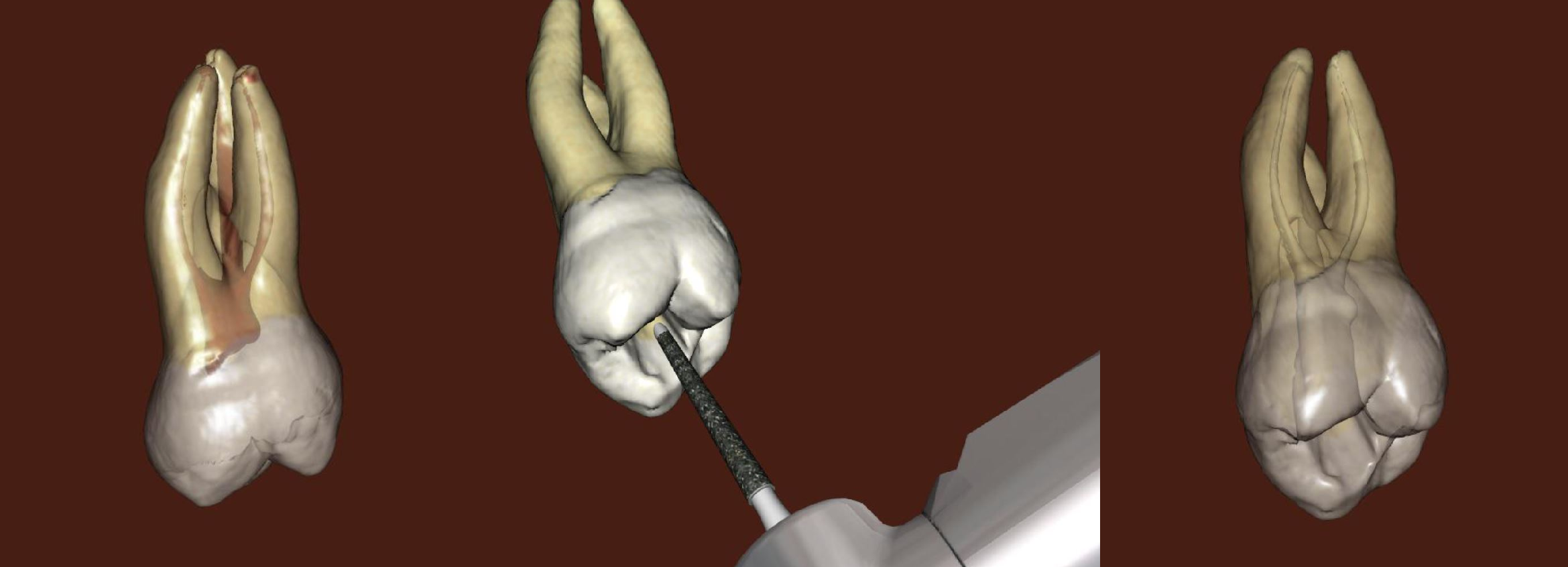 Nu ook delen van endodontische behandelingen in Simodont - Academisch ...
